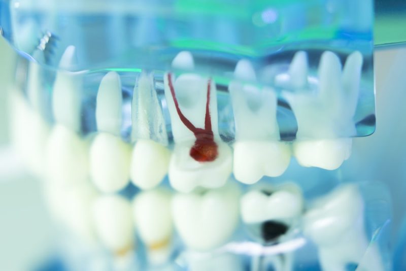 La pulpite : causes, symptômes et traitement | Clinique St-Charles